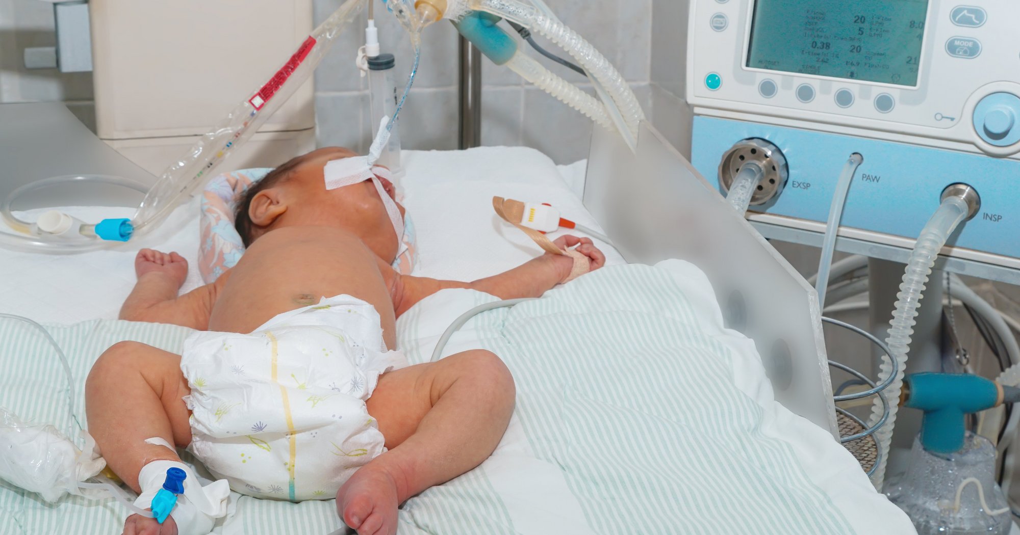 Baby stabilization & resuscitation in NICU - www.neopedia.org